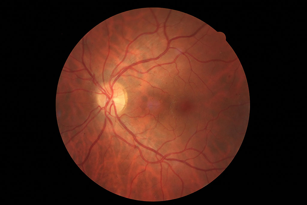 Retinal Imaging – Bender Eye Tustin Optometrist