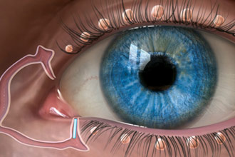 Plug Tear Ducts – Bender Eye Tustin Optometrist